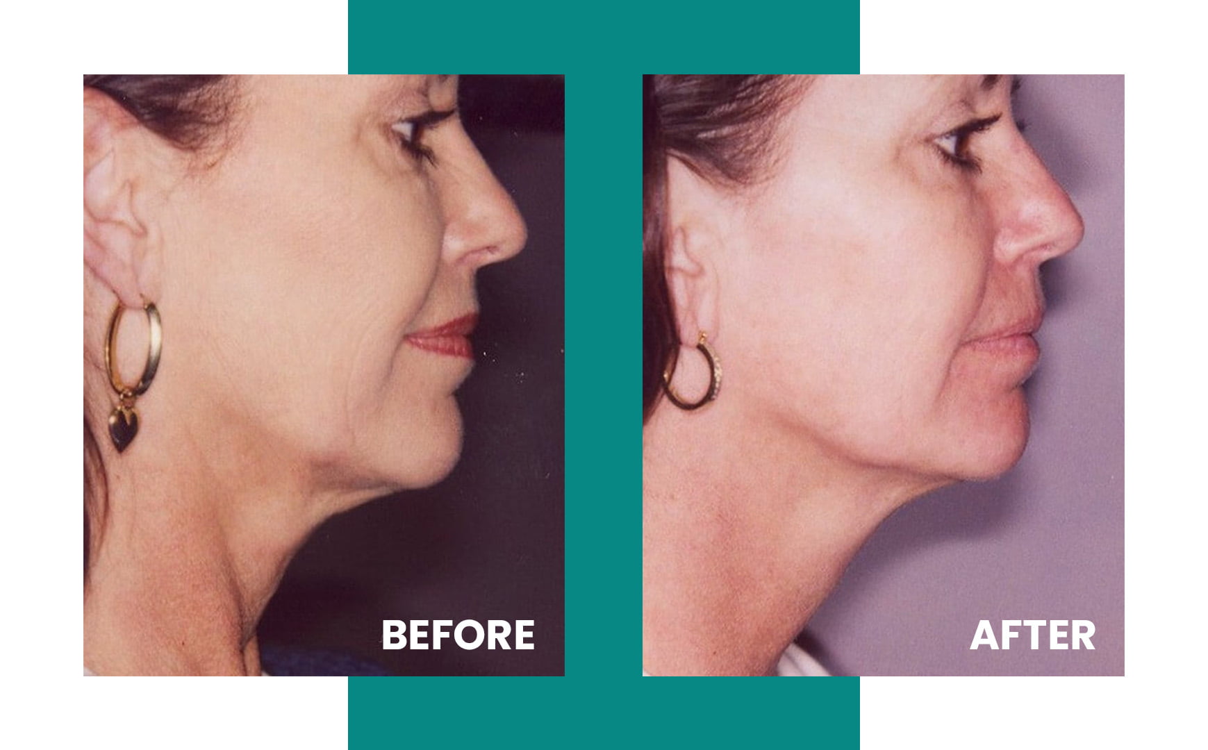 Botox Transformation Before & After | Lasting Skin Solutions