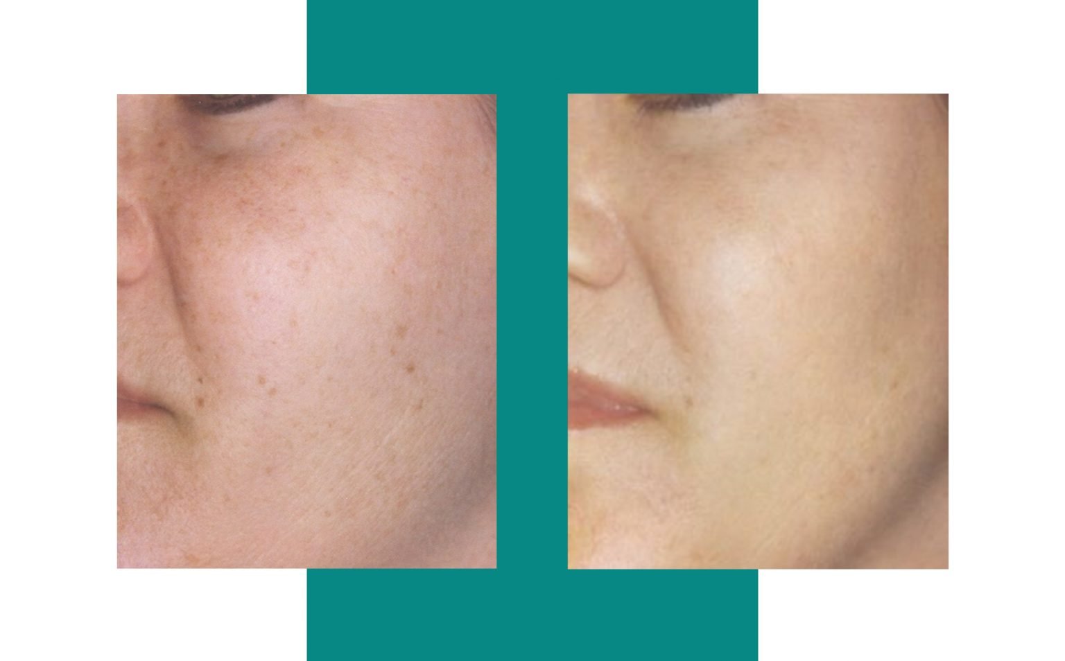 Procedure Gallery | Madison Cosmetic Skin Care Treatments