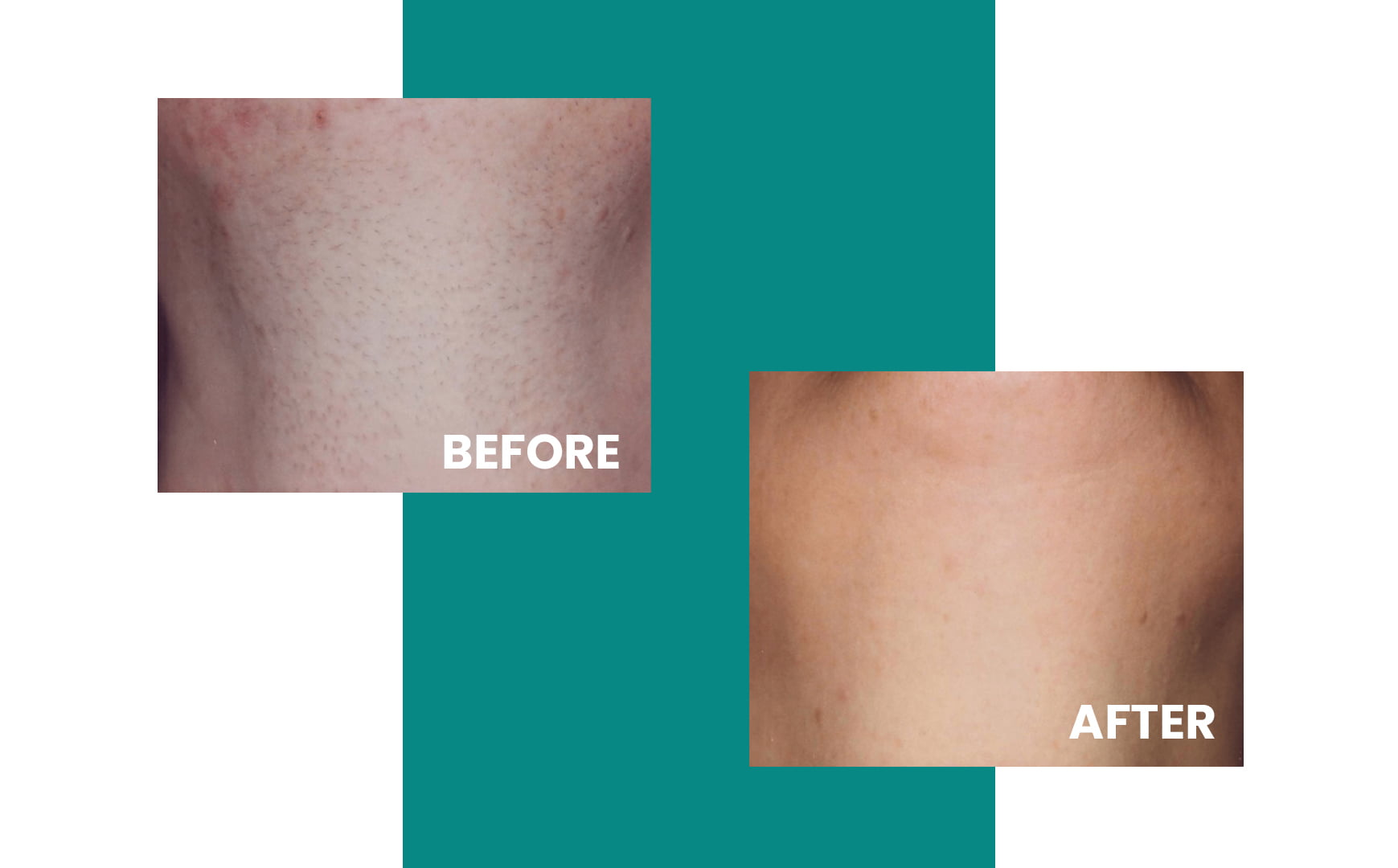 Permanent Back Hair Removal | Lasting Skin Solutions