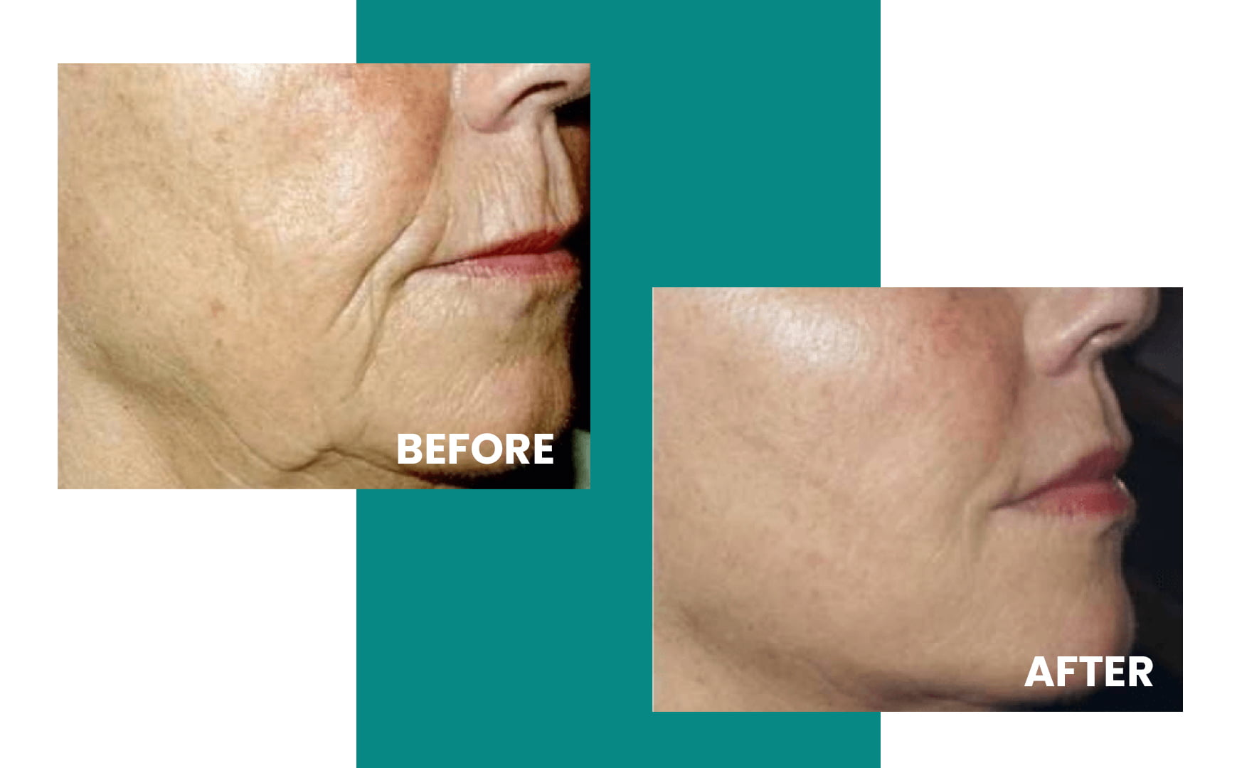 Wrinkle Fillers Milwaukee | Lasting Skin Solutions
