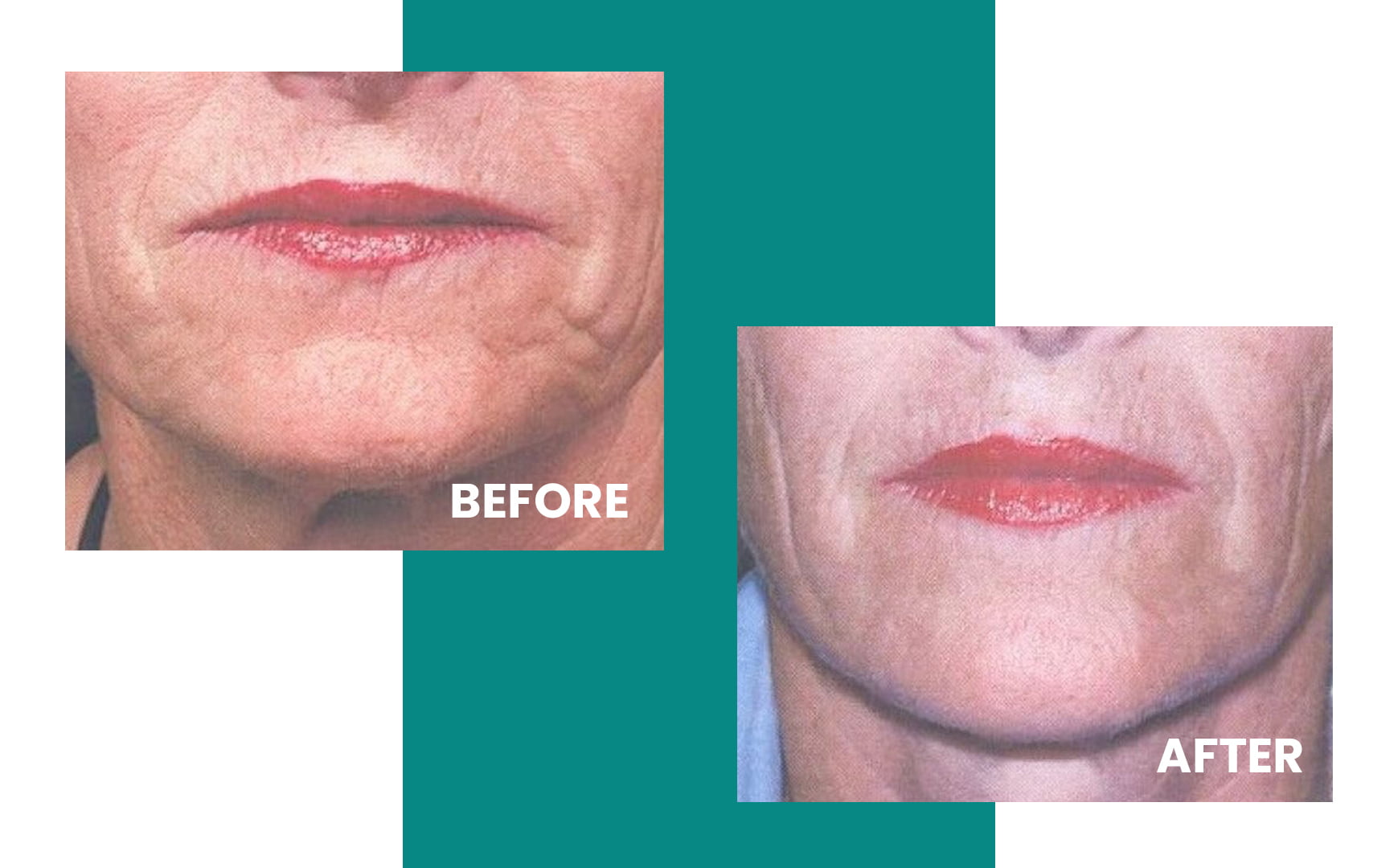 Botox for Deep Chin Wrinkles | Lasting Skin Solutions