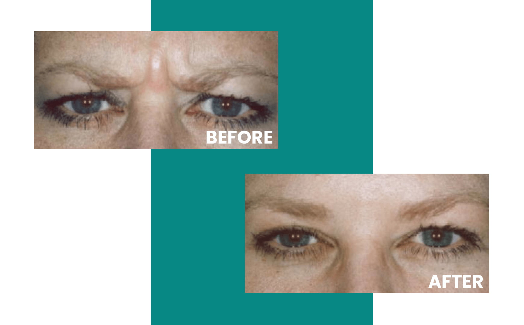 Deep Forehead Wrinkles | Lasting Skin Solutions