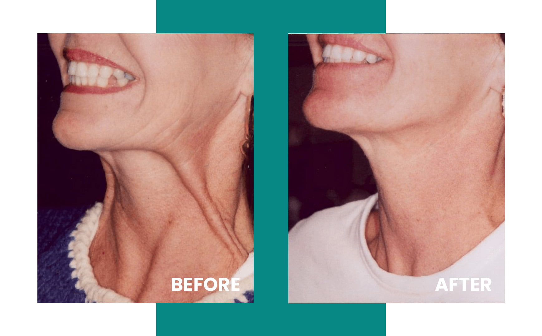 Botox Neck Rejuvenation | Lasting Skin Solutions