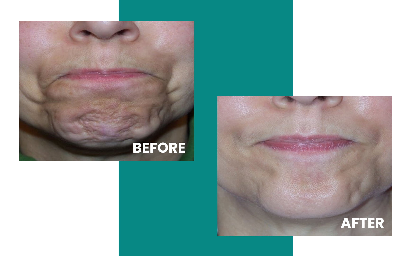 Botox Facial Fillers Transformation | Lasting Skin Solutions
