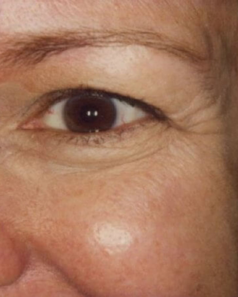 Crow's Feet Treatment | Lasting Skin Solutions | Madison, WI
