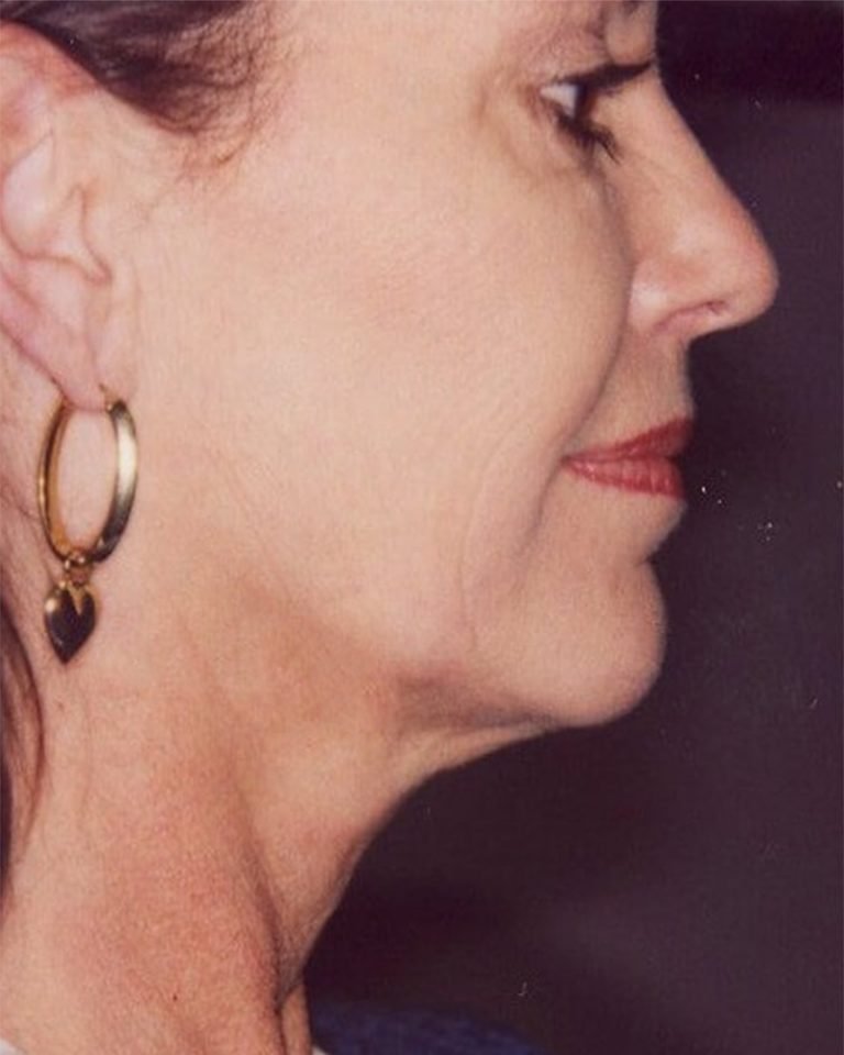 Botox Transformation Before & After | Lasting Skin Solutions