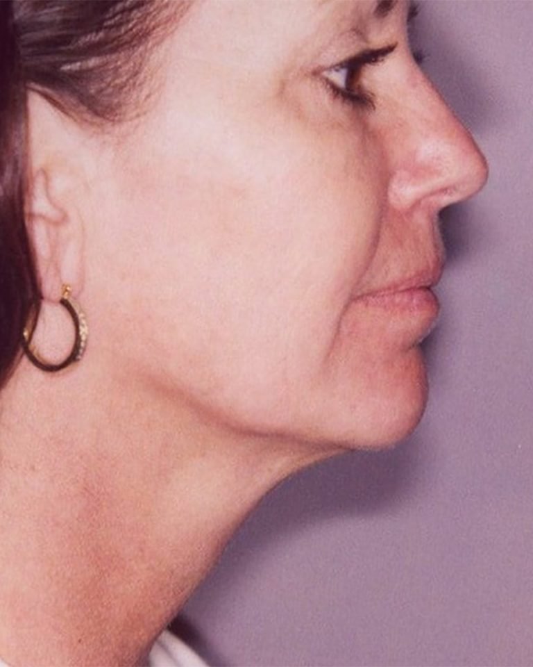 Botox Transformation Before & After | Lasting Skin Solutions