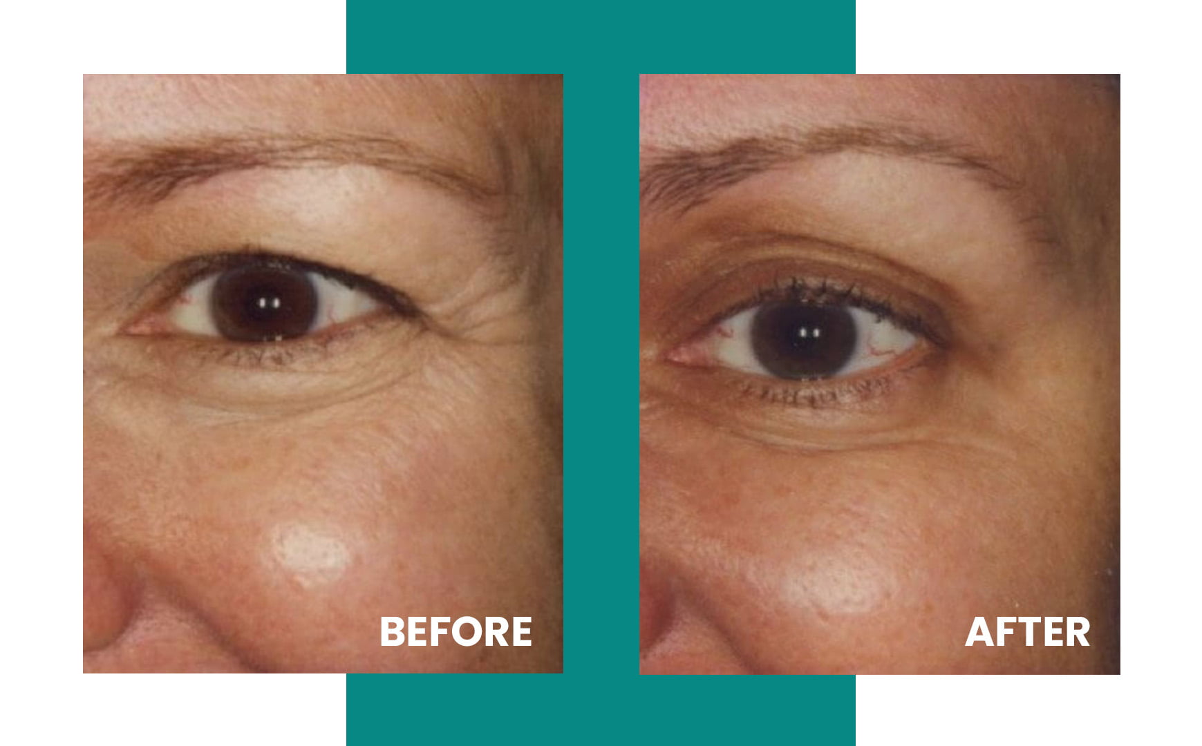Crow's Feet Treatment | Lasting Skin Solutions | Madison, WI